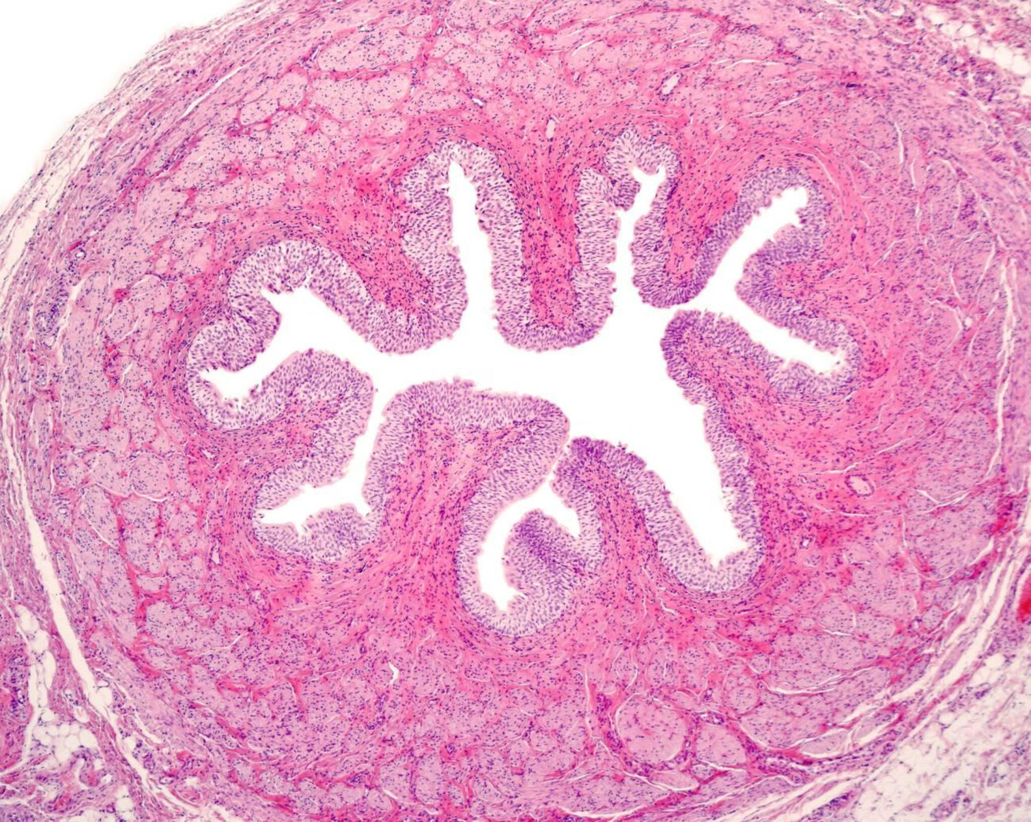 What Should I Do After Pyeloplasty? - Z Urology