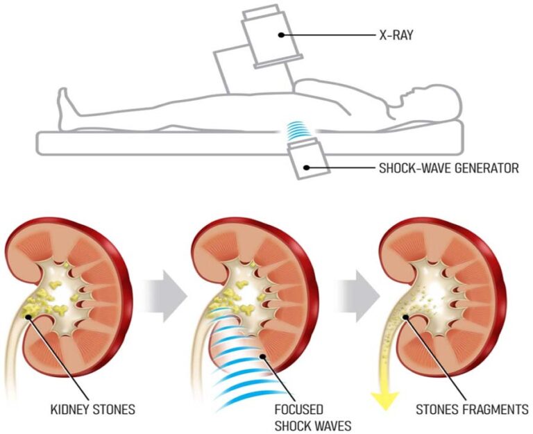 Extracorporeal Shock Wave Lithotripsy (ESWL) for Kidney Stones | Z Urology